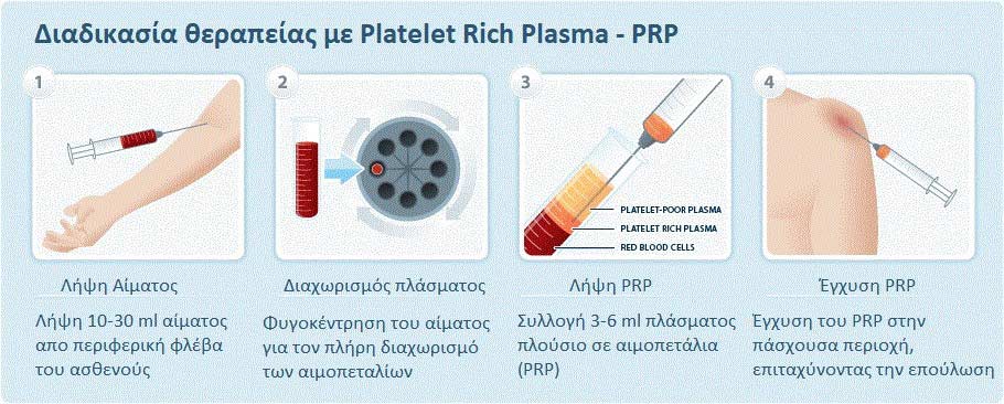Βιολογική Θεραπεία PRP | Ορθοπαιδικός Χειρουργός | Γεωργούδης Μ.