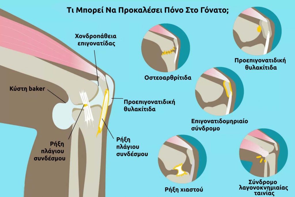 Συνήθεις Κακώσεις Γόνατος: Πώς αντιμετωπίζονται; | Γεωργούδης Μιχάλης